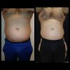 Nonsurgical Body Sculpting & Skin Tightening NO Surgery
